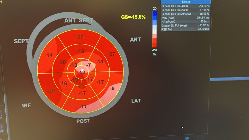 Strain imaging - Lakeview Cardiology of Texas